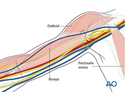 Extended deltopectoral approach to the humeral shaft