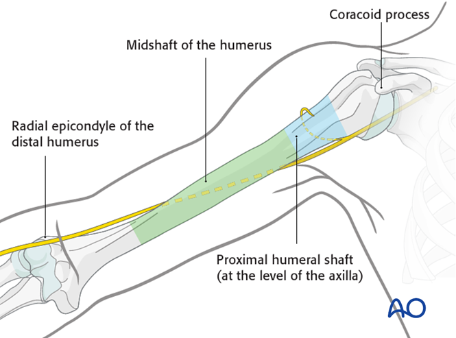 Extended deltopectoral approach to the humeral shaft
