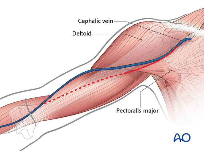 Extended deltopectoral approach to the humeral shaft
