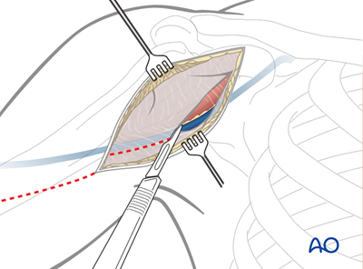 Extended deltopectoral approach to the humeral shaft
