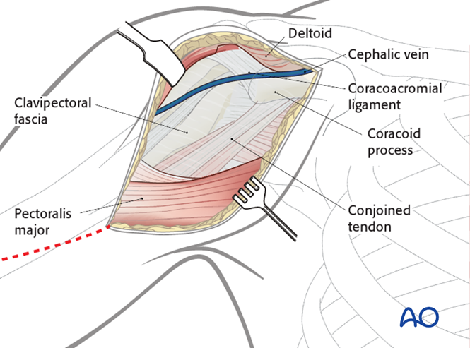 Extended deltopectoral approach to the humeral shaft