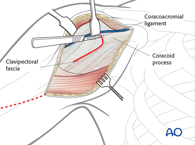 Extended deltopectoral approach to the humeral shaft