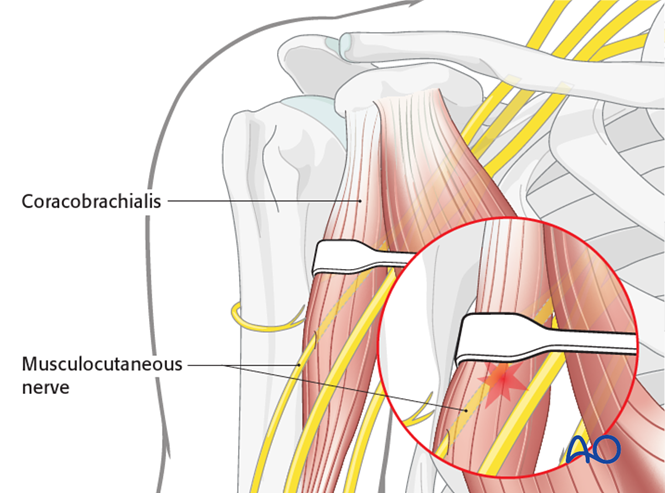 Extended deltopectoral approach to the humeral shaft