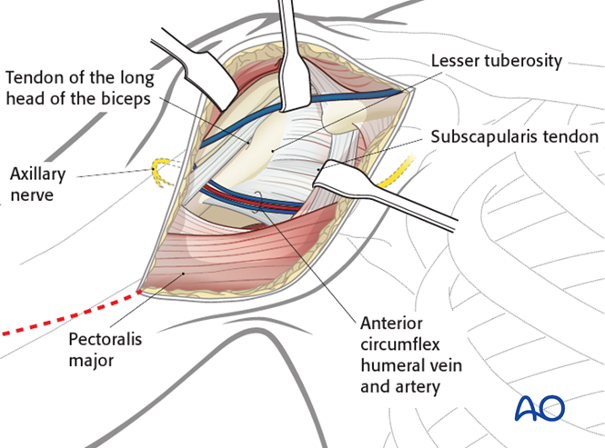 Extended deltopectoral approach to the humeral shaft
