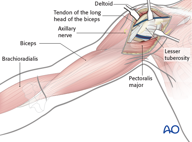 Extended deltopectoral approach to the humeral shaft