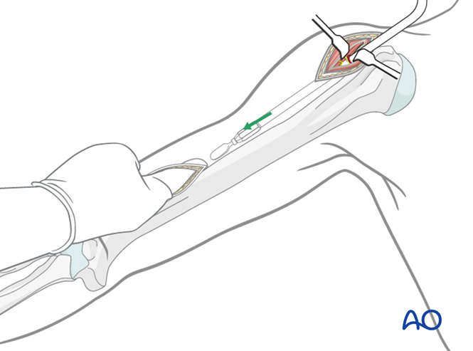 MIO transdeltoid lateral approach to the humerus
