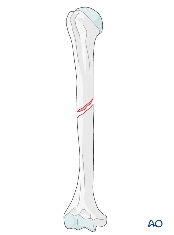 Simple fracture, oblique