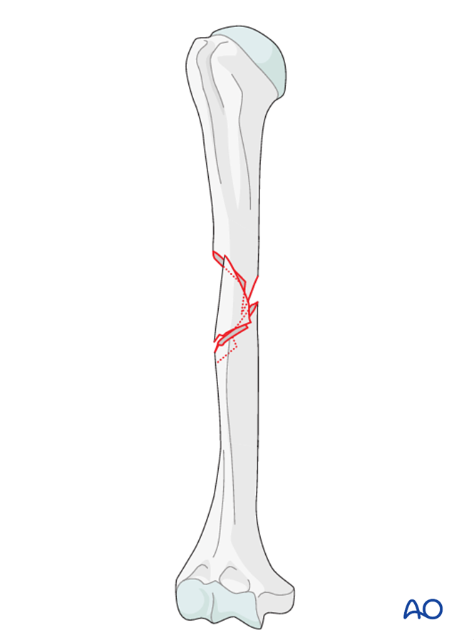 Wedge fracture, intact wedge