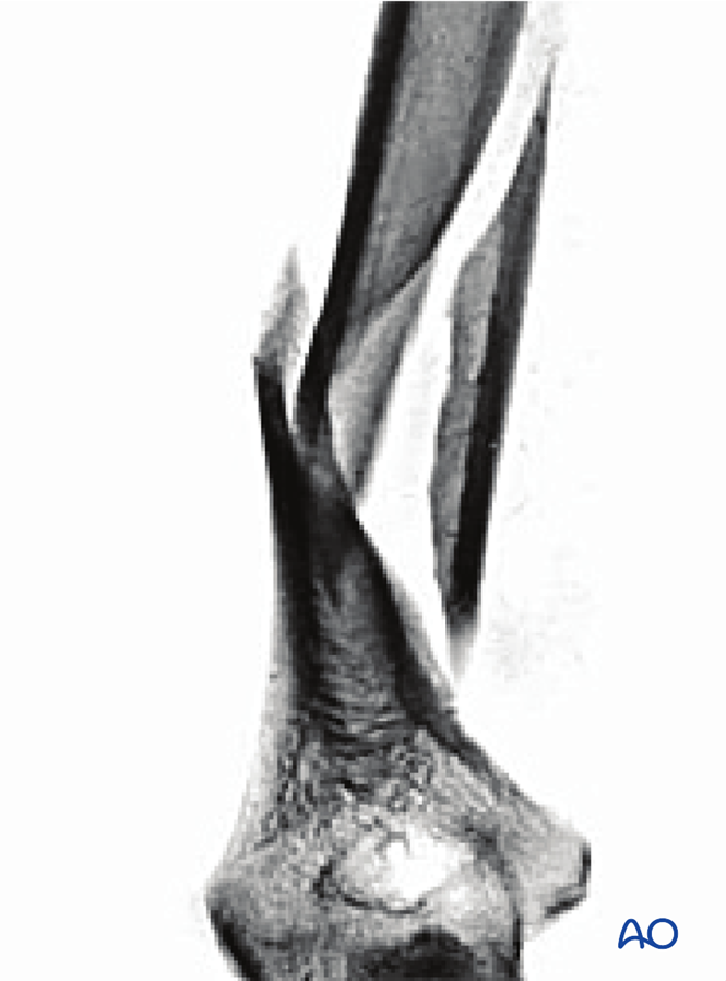 Wedge fracture, intact wedge