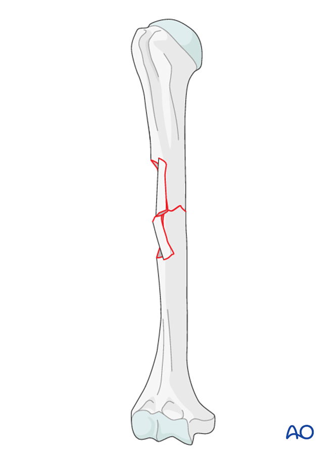 Wedge fracture, fragmentary wedge