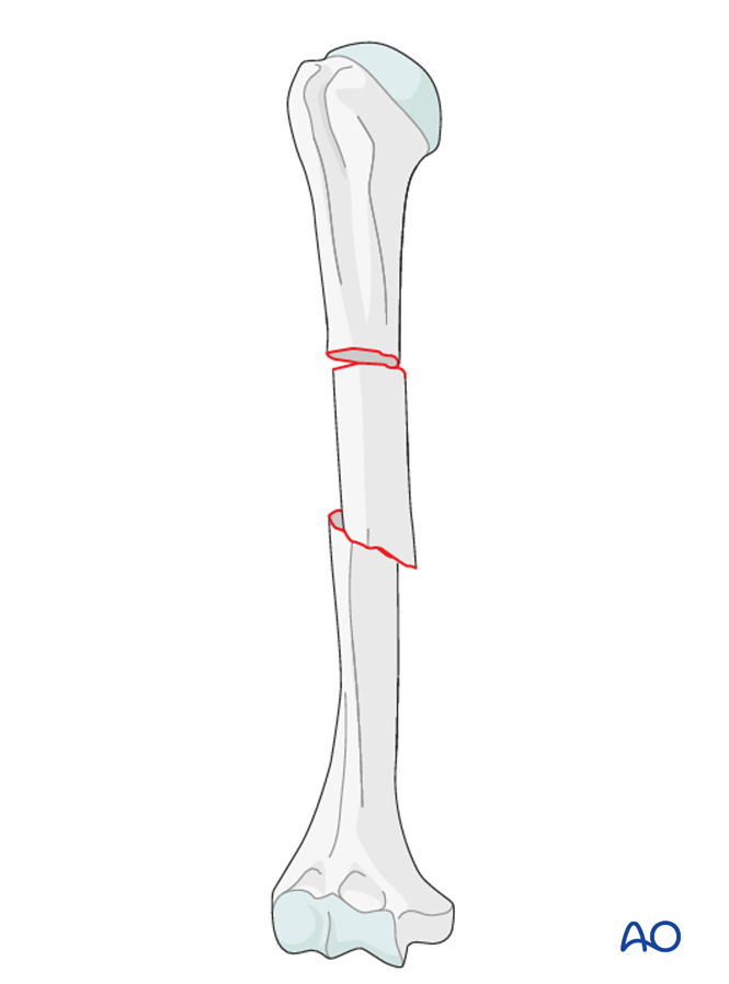 Multifragmentary fracture, intact segment