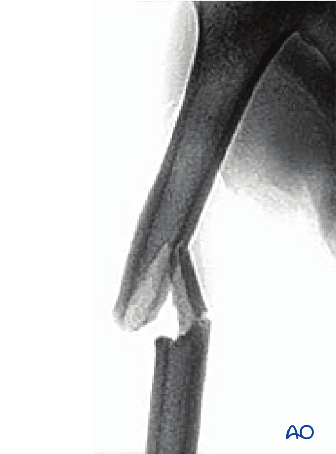 Wedge fracture, intact wedge