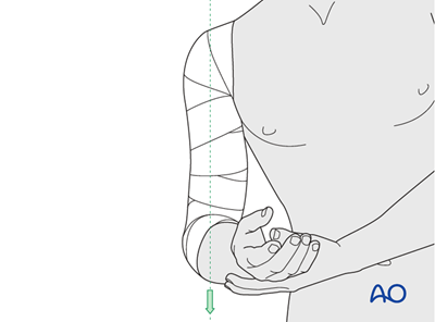 Nonoperative treatment for Simple fracture, spiral