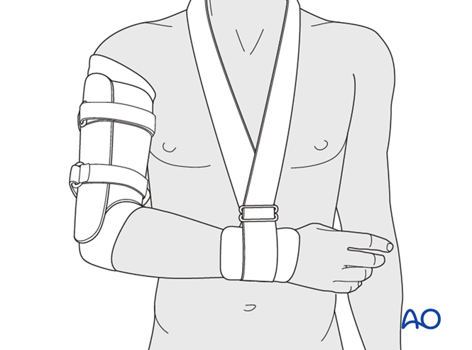 Nonoperative treatment for Wedge fracture, intact wedge