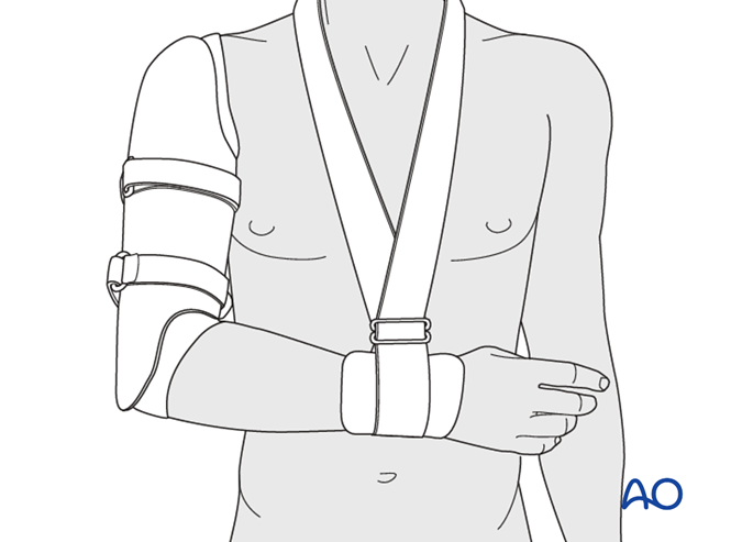 Nonoperative treatment for Wedge fracture, intact wedge