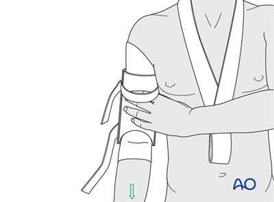 Nonoperative treatment for Simple fracture, transverse
