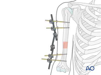 External fixation for Simple fracture, spiral