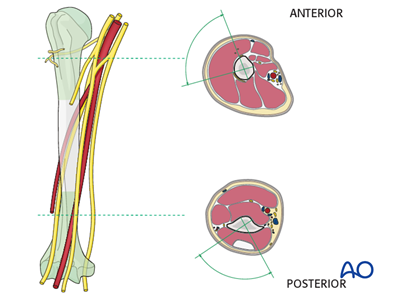External fixation for Simple fracture, oblique