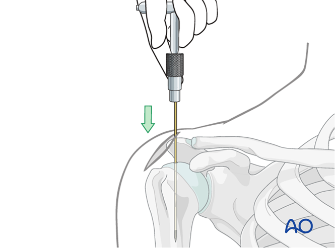 Antegrade nailing for Simple fracture, spiral