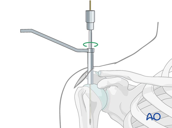 Antegrade nailing for Simple fracture, spiral