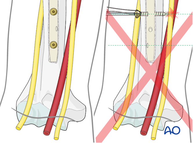 Antegrade nailing for Simple fracture, spiral
