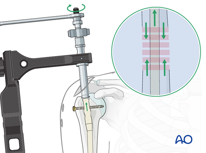 Antegrade nailing - bent nail