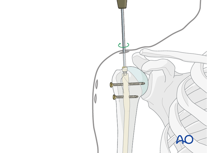 Antegrade nailing - bent nail