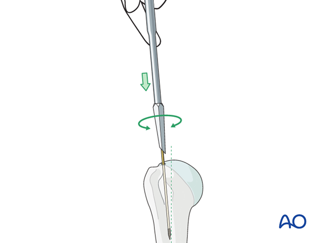 Antegrade nailing - bent nail