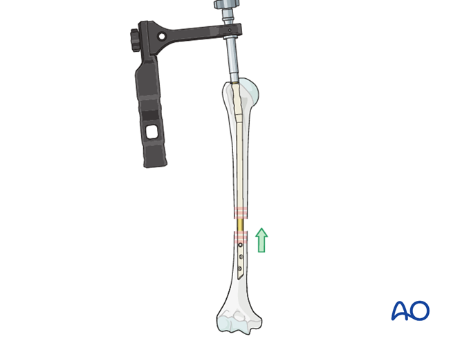 Antegrade nailing - bent nail