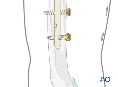 Antegrade nailing - bent nail