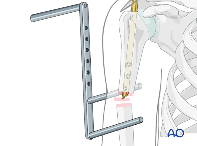 Antegrade nailing - bent nail