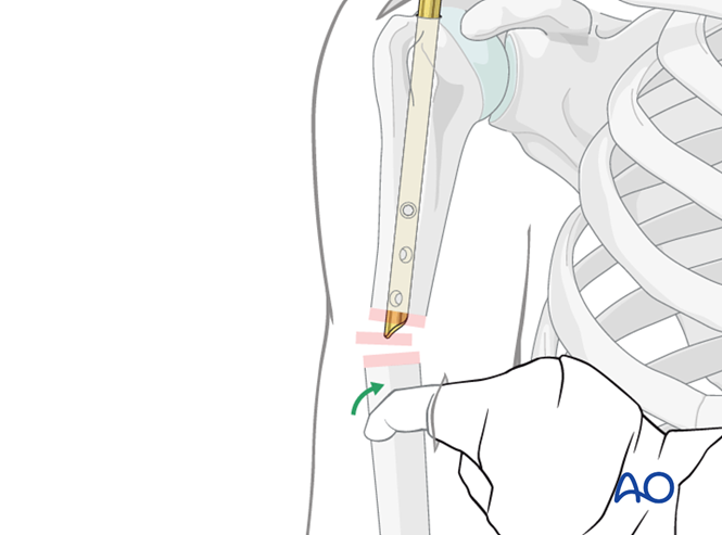 Antegrade nailing - bent nail