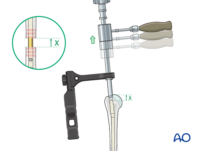 Antegrade nailing - bent nail