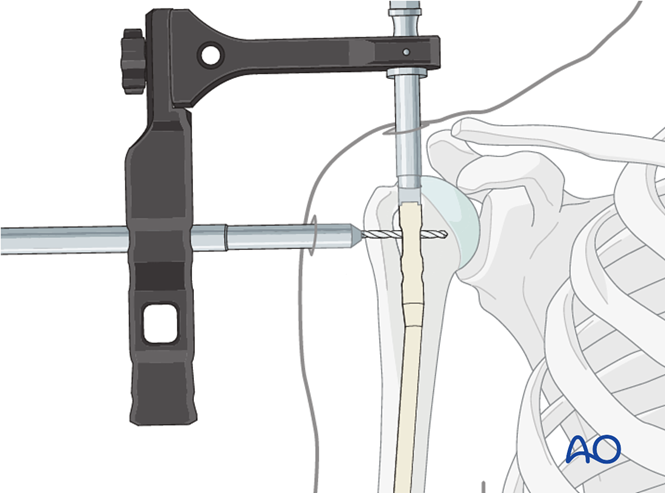 Antegrade nailing - bent nail