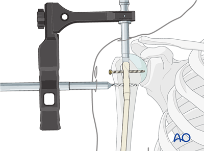 Antegrade nailing - bent nail