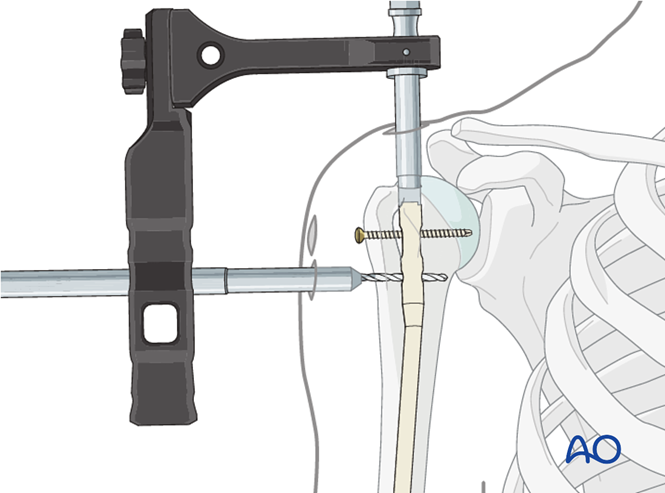 Antegrade nailing - bent nail