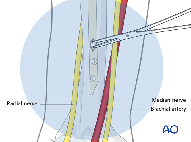 Antegrade nailing - bent nail