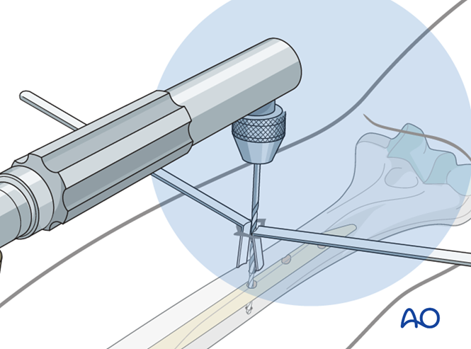 Antegrade nailing - bent nail