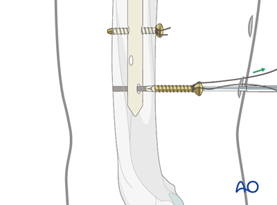 Antegrade nailing - bent nail