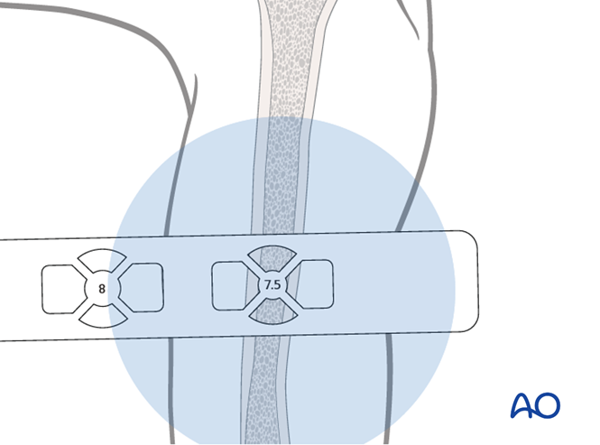 Retrograde nailing for Simple fracture, transverse