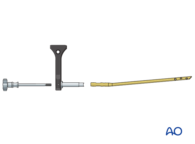 Retrograde nailing for Simple fracture, transverse