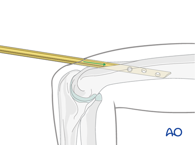 Retrograde nailing for Simple fracture, transverse