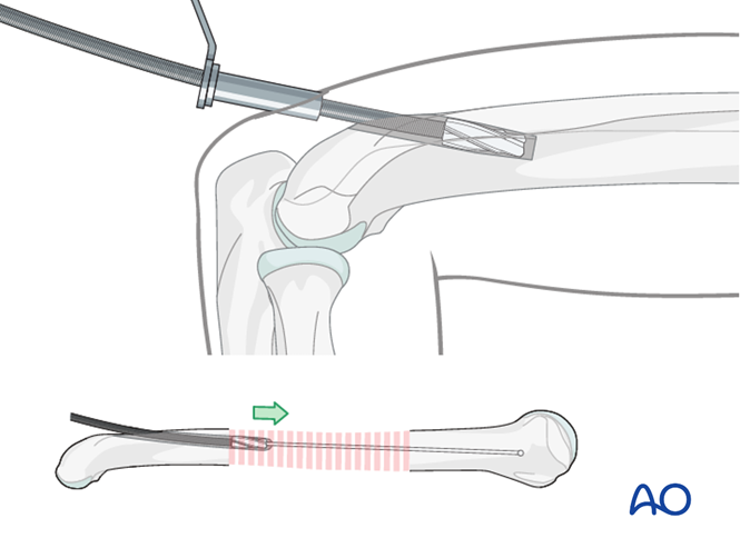 Retrograde nailing for Simple fracture, transverse
