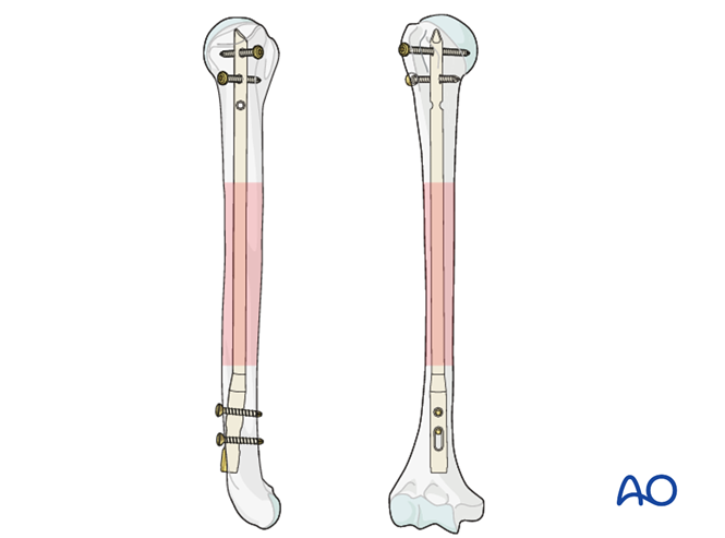 Retrograde nailing for Simple fracture, transverse
