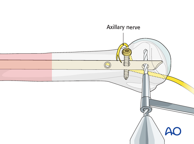 Retrograde nailing for Simple fracture, transverse