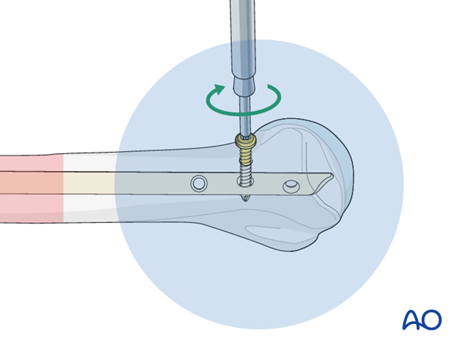 Retrograde nailing for Simple fracture, transverse