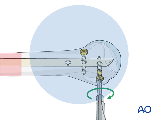 Retrograde nailing for Simple fracture, transverse