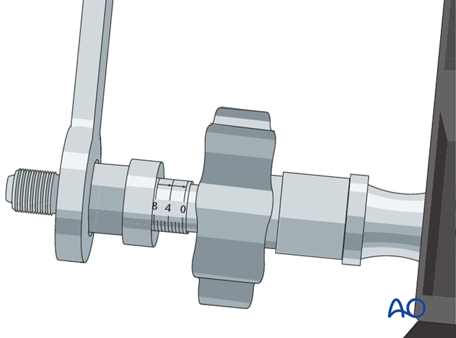 Retrograde nailing for Simple fracture, transverse
