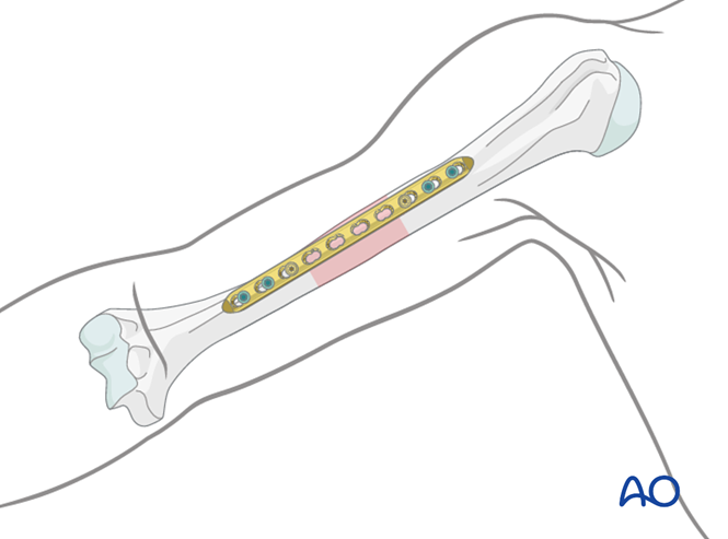 MIO - Bridge plating for Simple fracture, spiral
