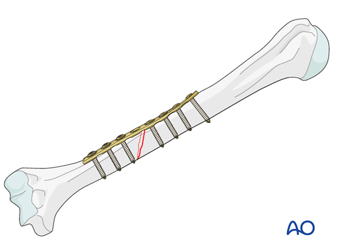 ORIF - Compression plating for Simple fracture, oblique